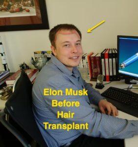 Elon Musk Hair Transplant: The Shocking Truth Behind His Hair ...